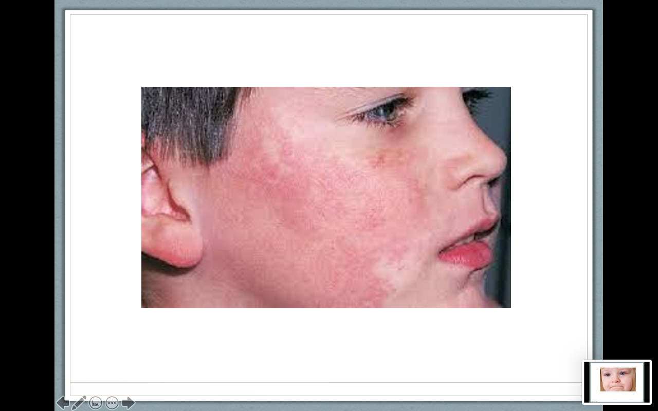 Childhood Disease Matching Game | eCampusOntario H5P Studio